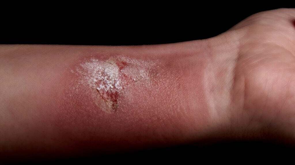 dog bite marks removal